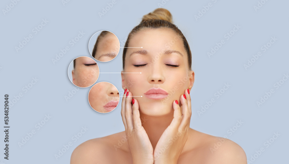 Dark spots, freckles,hyperpigmentation(melasma or chloasma),concept ...