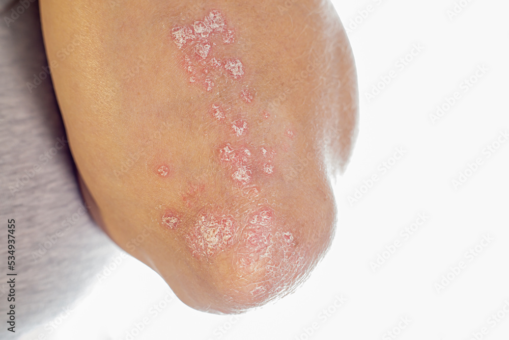 Psoriasis on elbows .Close up autoimmune incurable dermatological skin ...