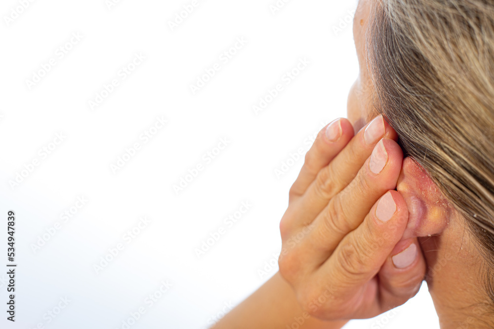 Psoriasis behind the ear. Psoriatic redness, peeling and crusting ...