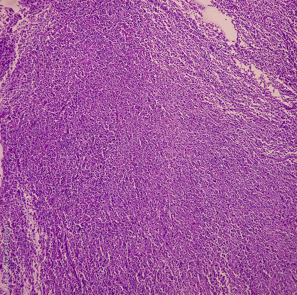 Photomicrograph of lymph node with Hodgkin's Disease (lymphoma ...