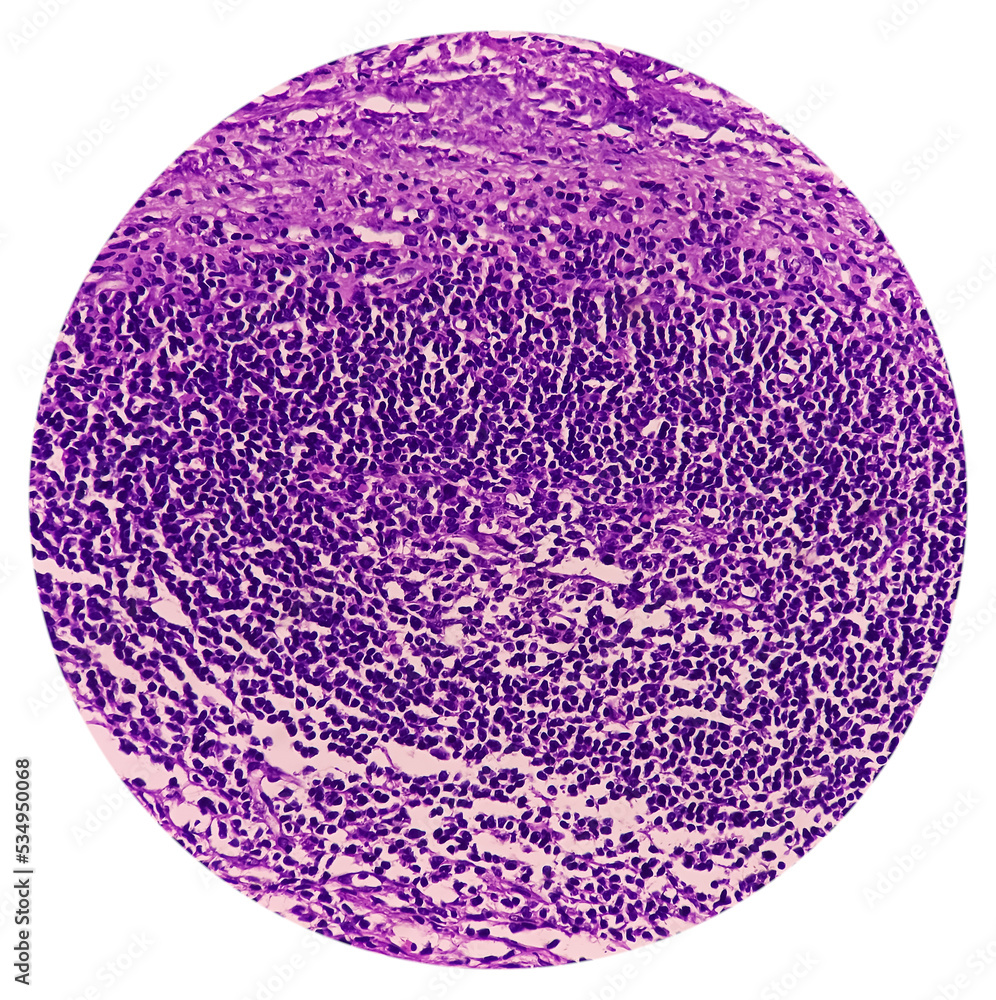 Photomicrograph of lymph node with Hodgkin's Disease (lymphoma ...