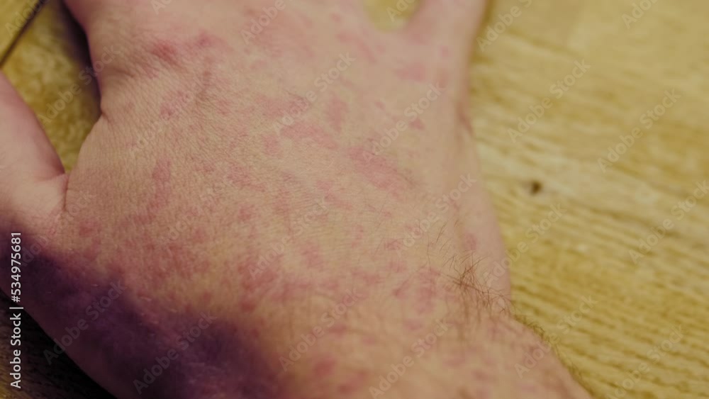 Food Allergy, Lot of red spots or rash on the skin all of a man hand ...