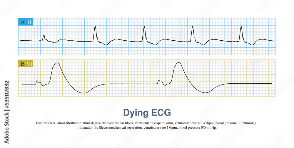 Electromechanical separation is an ECG of cardiac arrest. The heart has ...