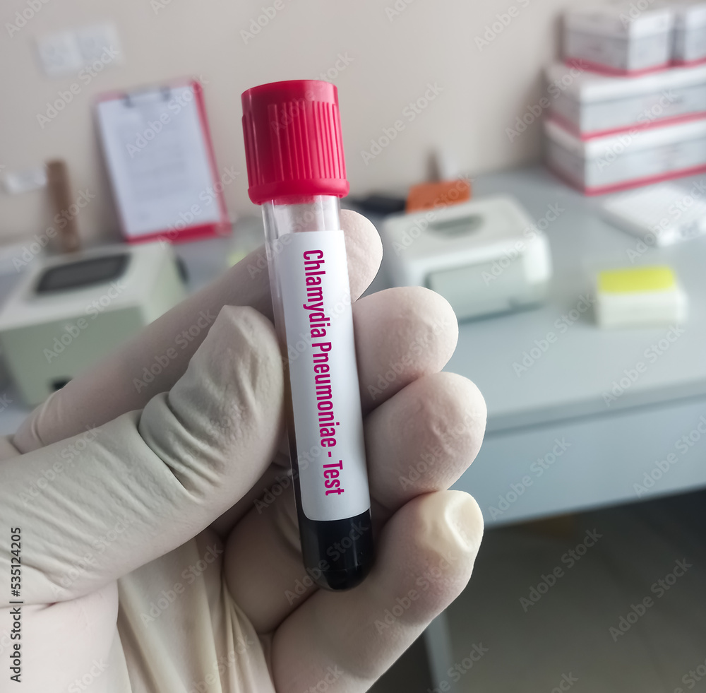 Blood sample for Chlamydia pneumoniae (CP) test. Stock Photo | Adobe Stock