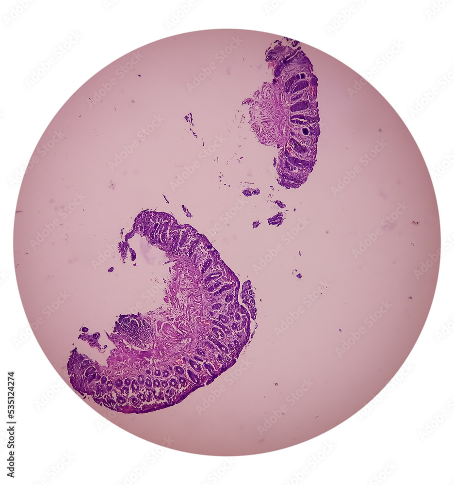 Tissue from rectum(colonoscopic biopsy): Chronic nonspecific proctitis ...