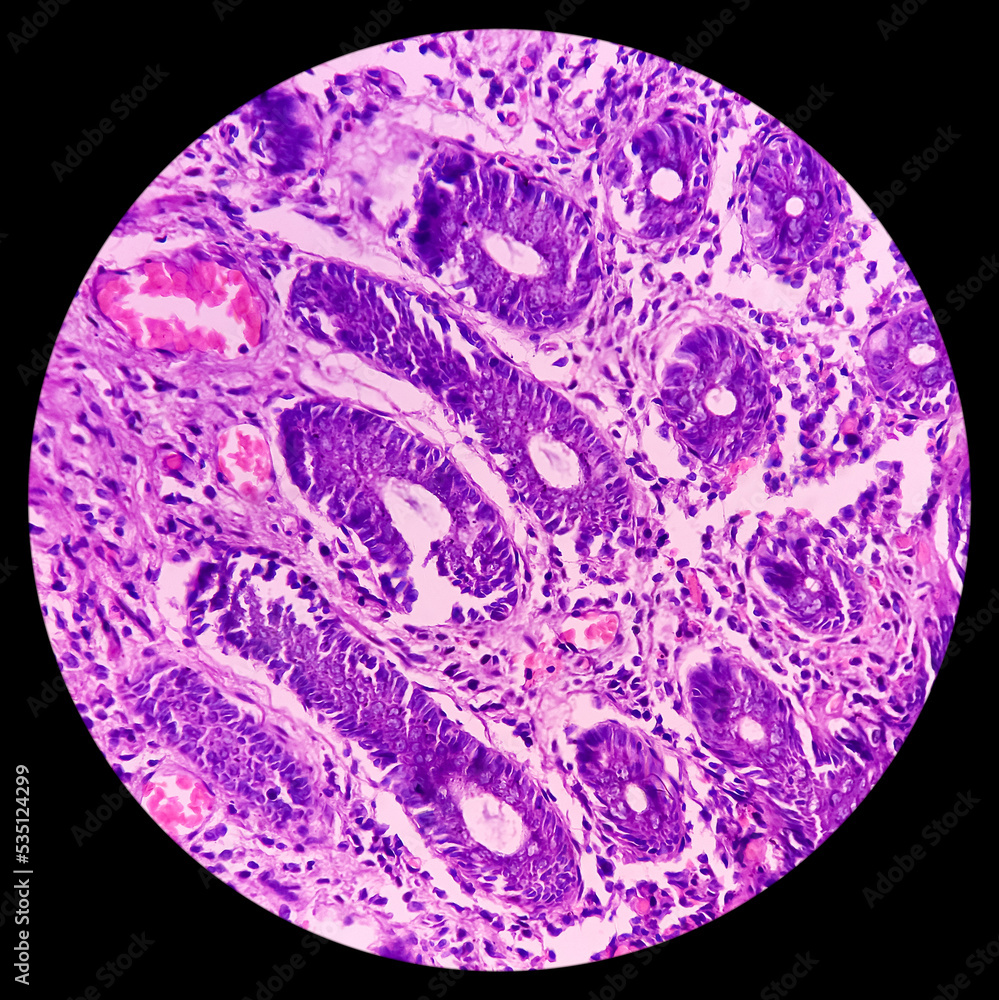 Tissue from rectum(colonoscopic biopsy): Chronic nonspecific proctitis ...