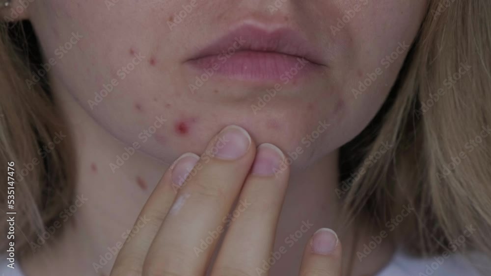 Unrecognizable woman showing her acne on face. Close-up acne on woman's ...