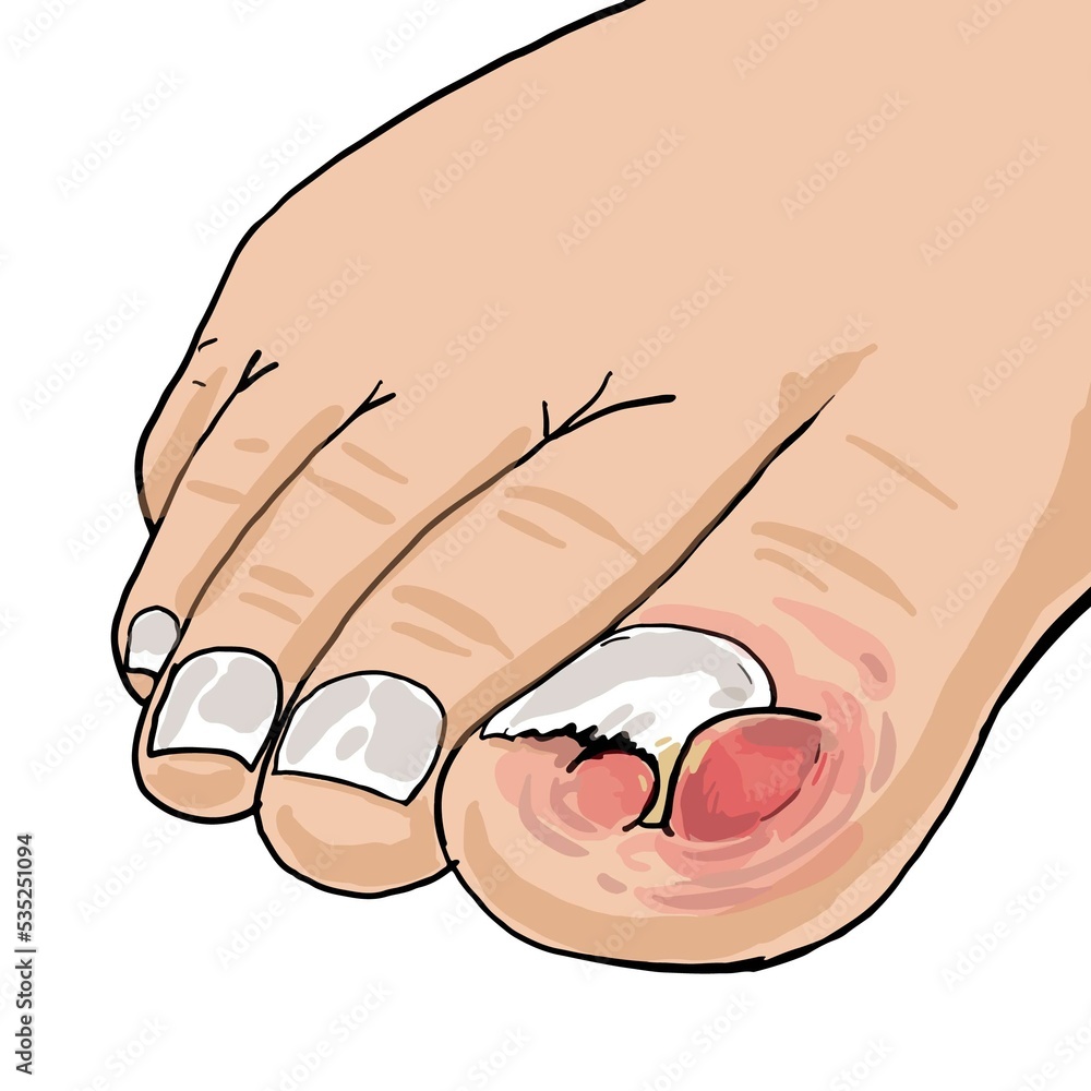 Injured toenails Stock Illustration | Adobe Stock