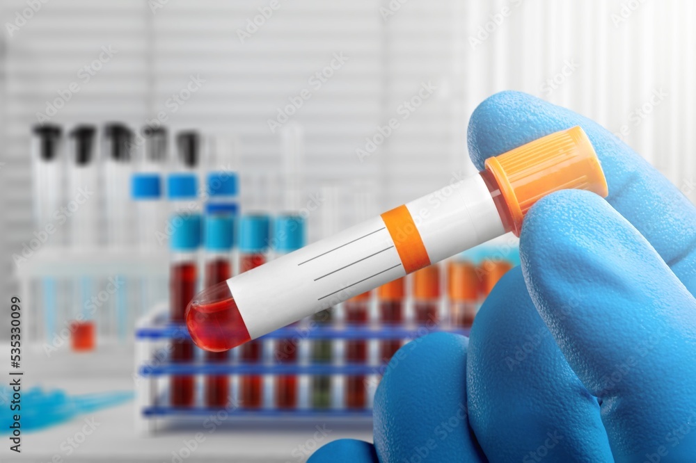 Blood sample tube for virus test. It is also known as the Moneypox ...
