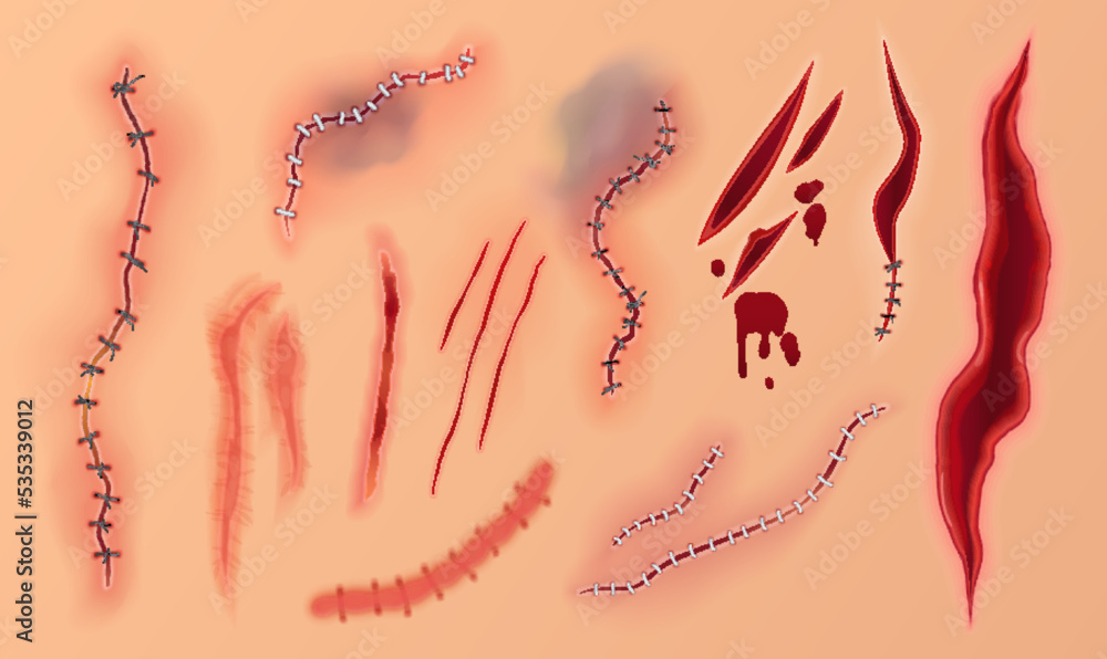 Realistic various surgical stitches, bloody wounds, scars, bruise and ...