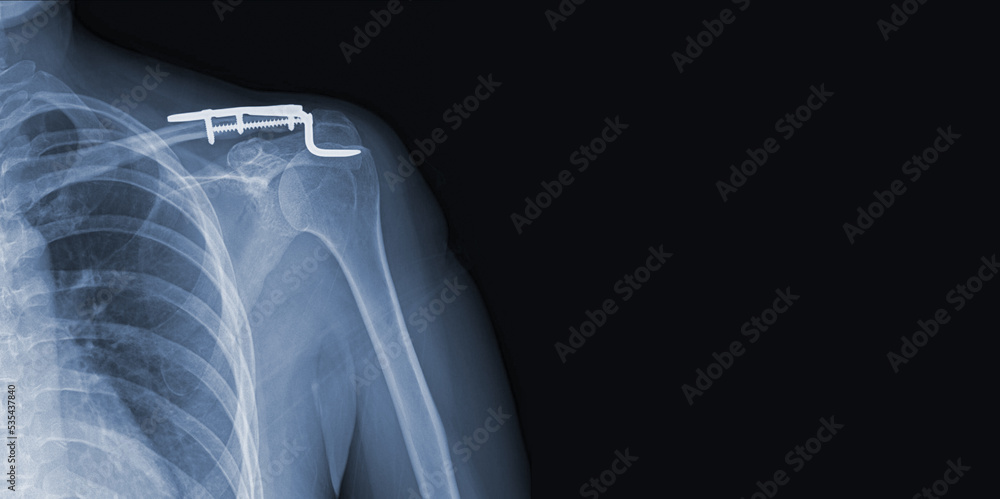 x-ray images of the shoulder joint modified coracoclavicular stabilizer ...