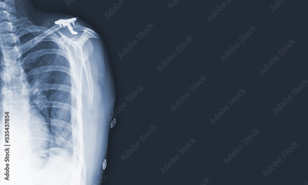 x-ray images of the shoulder joint modified coracoclavicular stabilizer ...