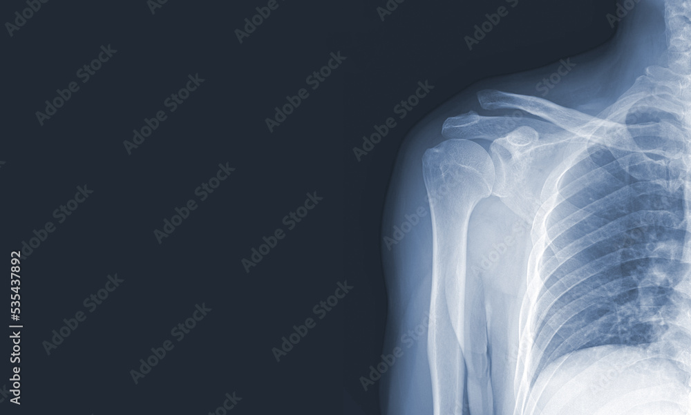 x-ray images of the shoulder joint to see injuries bones and tendons ...