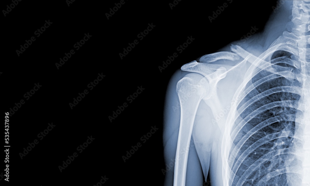 x-ray images of the shoulder joint to see injuries clavicle fracture ...