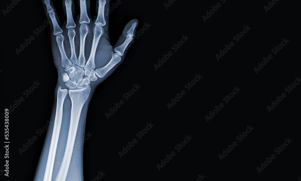 x-ray images of the hand and wrist joint to see injuries tendons soft ...