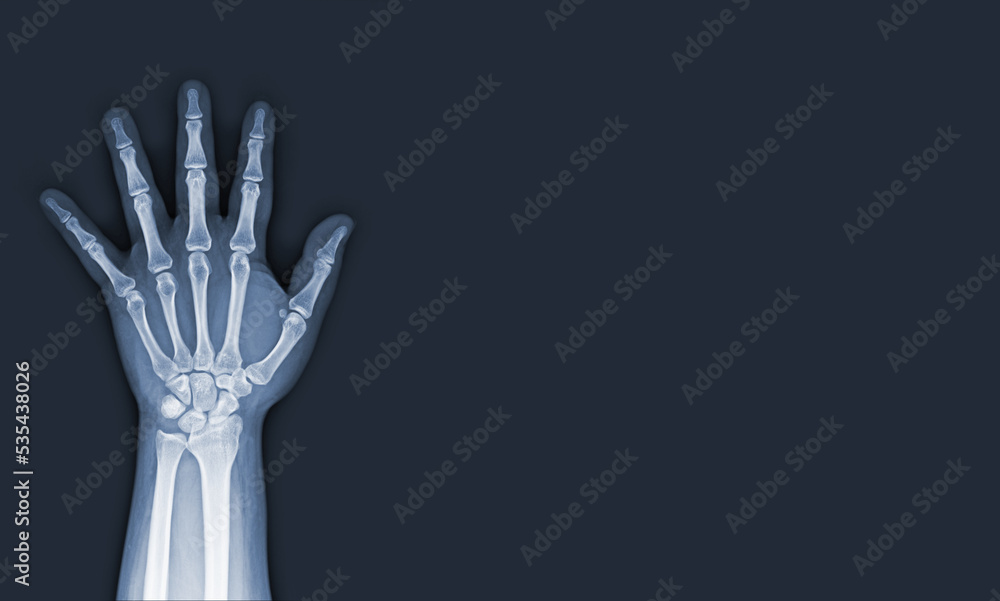 x-ray images of the hand and wrist joint AP views to see injuries ...