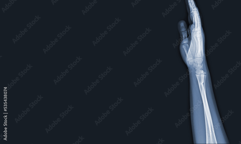 x-ray images of the hand and wrist joint lateral views to see injuries ...