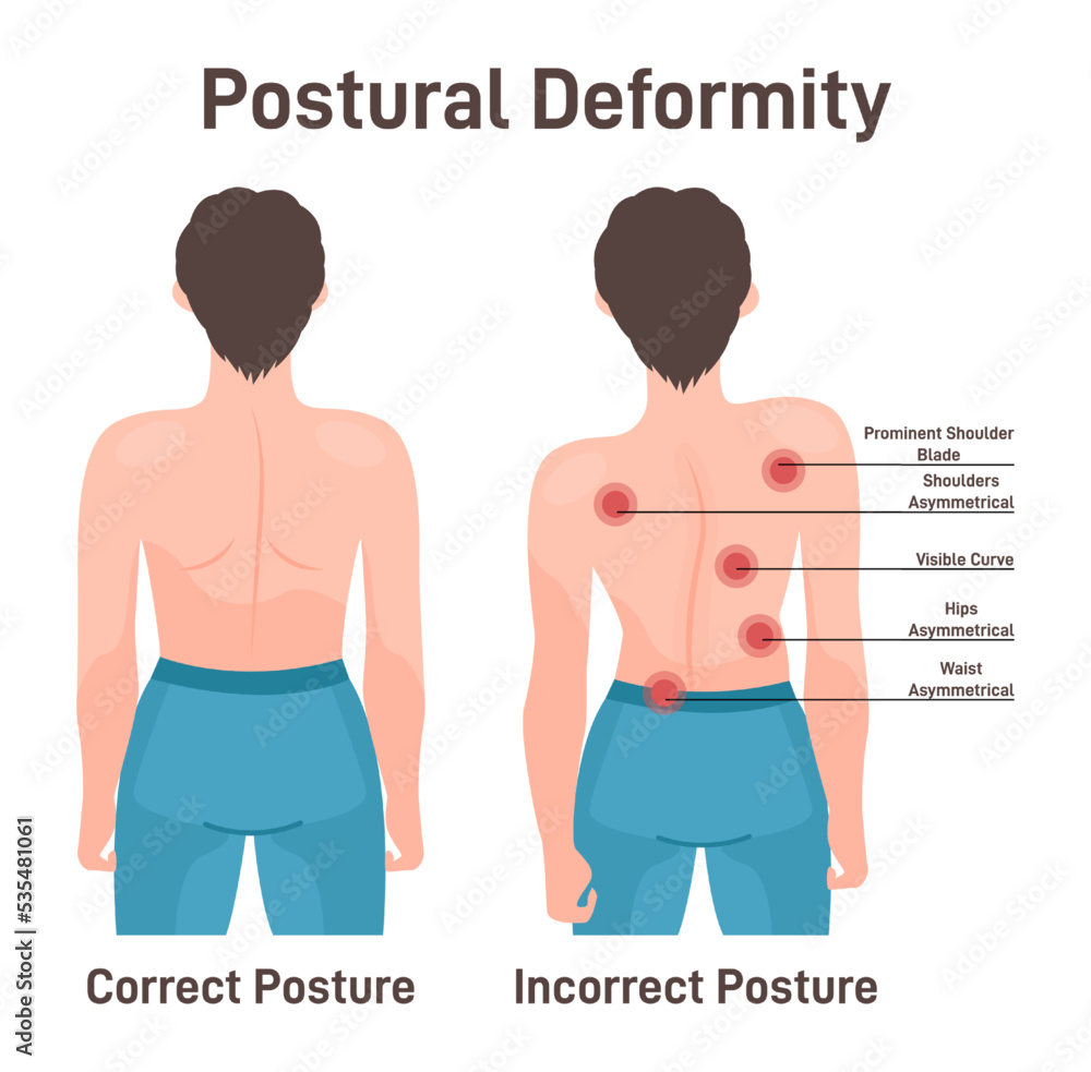 Postural deformity. Scoliosis, curvature illness of spine. Body posture ...