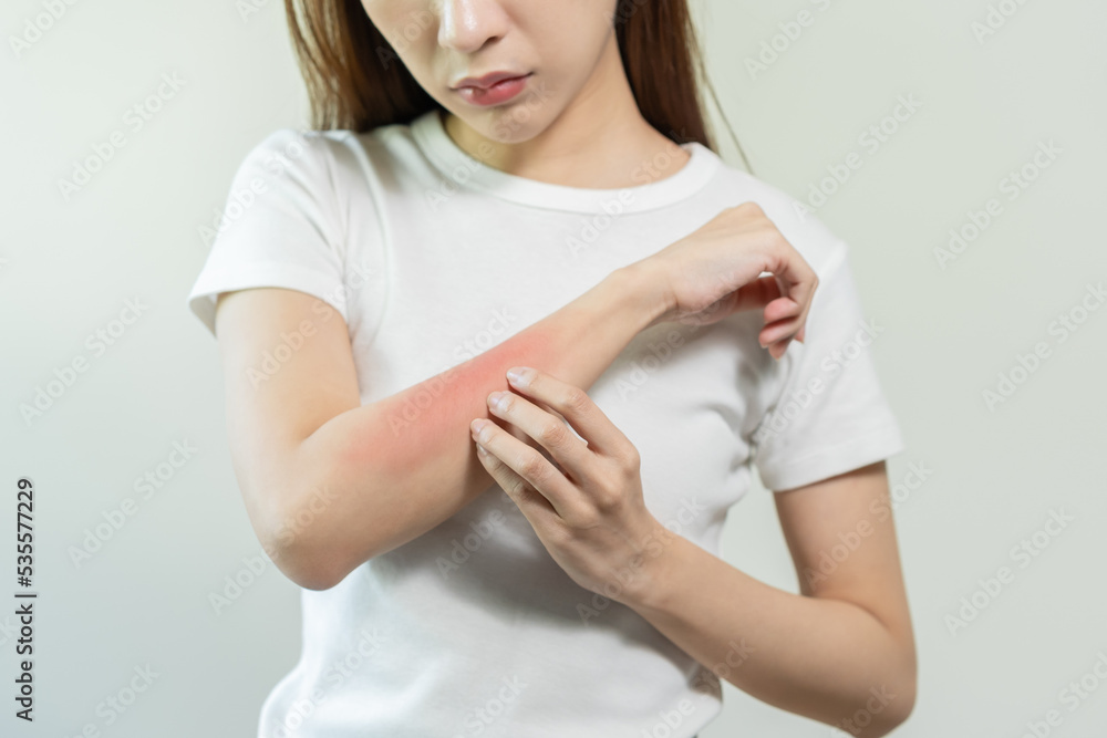 Dermatology asian young woman, girl allergy, allergic reaction from ...