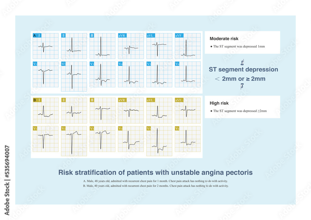 For acute coronary syndromes without ST segment elevation, ST segment ...