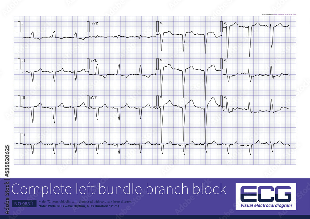 In complete left bundle branch block, the QRS wave in lead V1 is ...