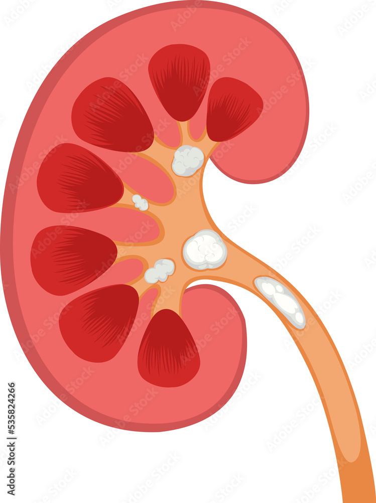 kidney stones Stock Illustration | Adobe Stock