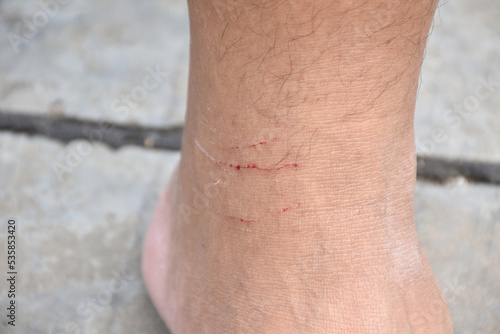 scar on the leg, after injury. The last stage of wound healing ...