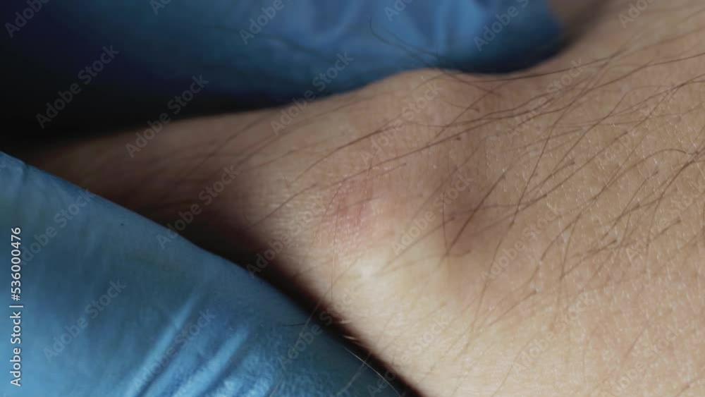 The doctor checks a subcutaneous tumor in a patient. Skin cancer ...