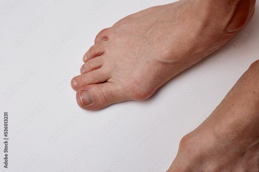Hallux valgus deformity of the foot on the girl's leg requires ...