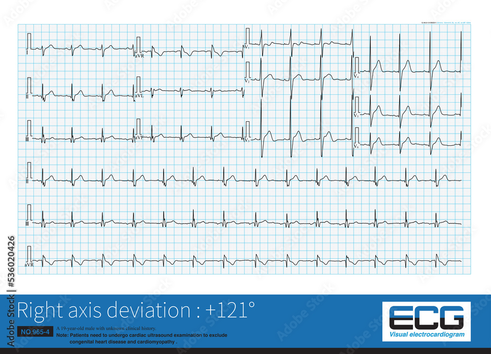 When the electrical axis deviates to the right, the maximum QRS vector ...