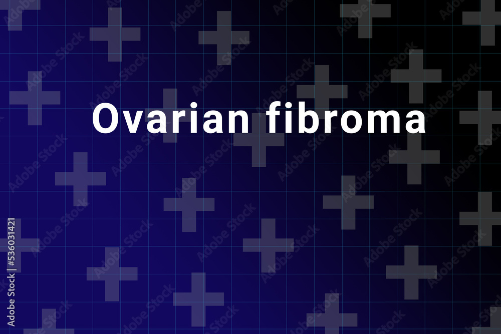 Ovarian fibroma disease Illustration. Ovarian fibroma title on medical ...