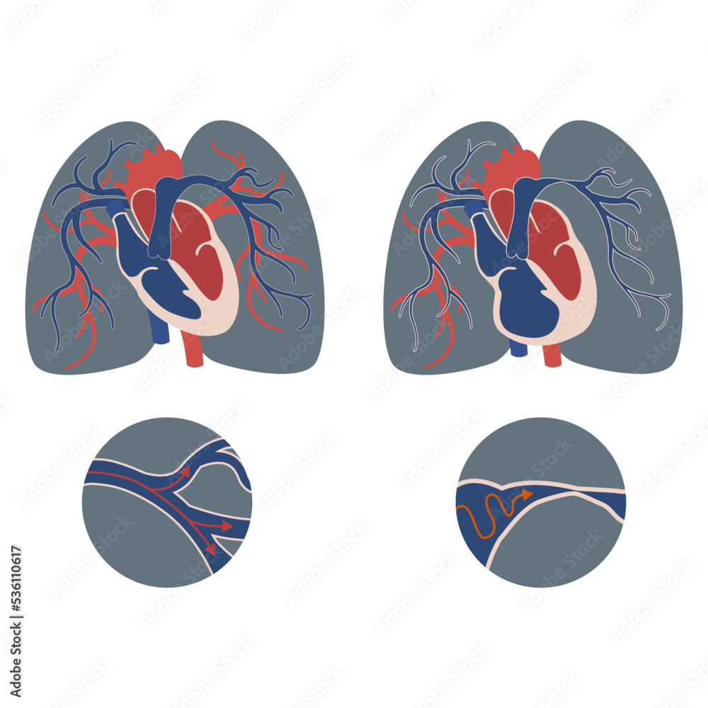 Pulmonary hypertension. Diagram with changes in the heart and arteries ...