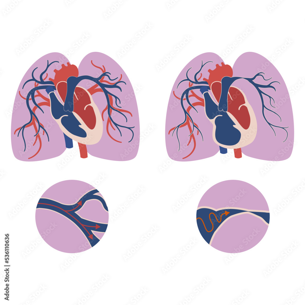 Pulmonary hypertension. Diagram with changes in the heart and arteries ...