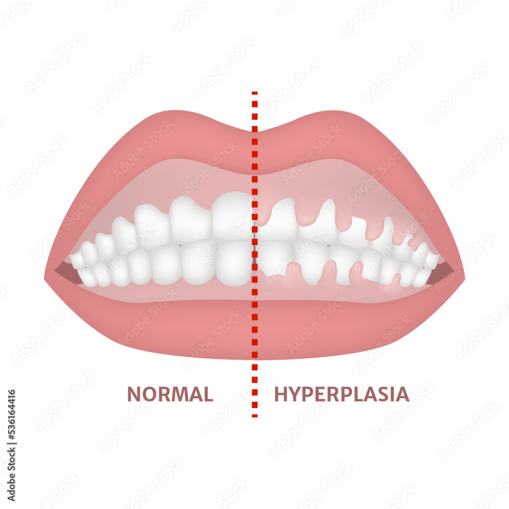 Poster Gingival hyperplasia. Medical poster. Vector illustration – Wall ...