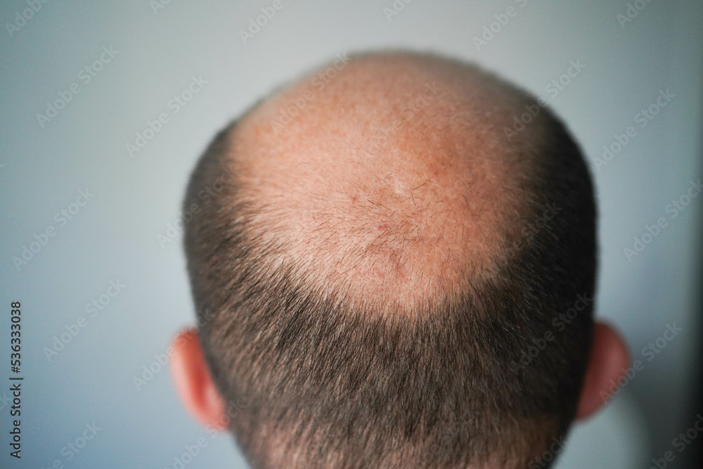 Bald head close-up. The problem of hair loss in men. Alopecia in men ...