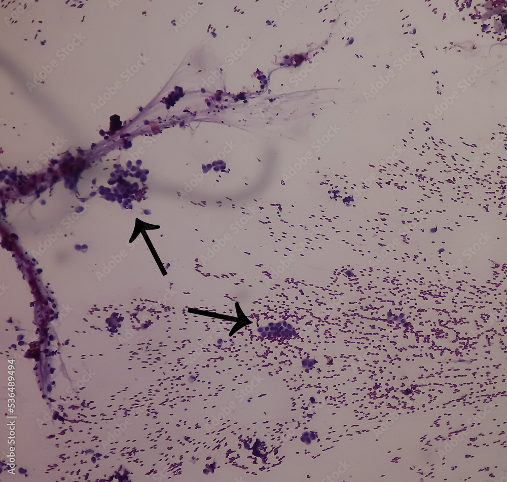 Axillary lymph node(FNA Cytology): Positive malignant cell, Metastatic ...