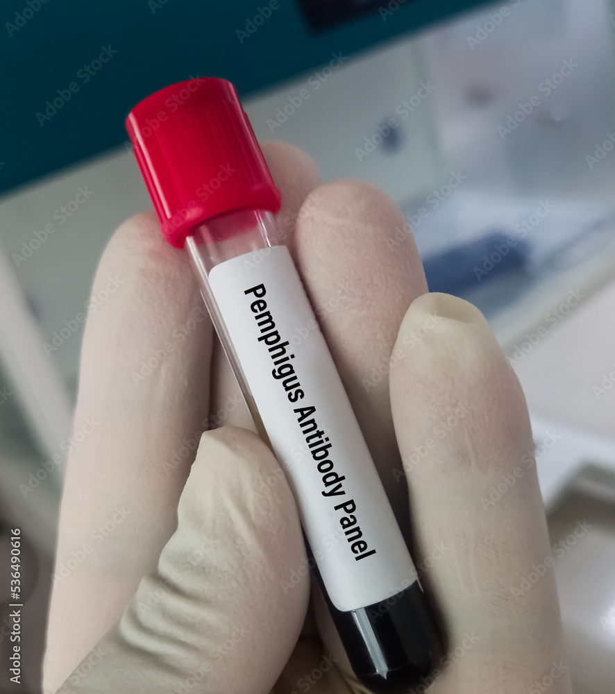 Hand holding blood sample for Pemphigus antibody panel, Pemphigus is an ...