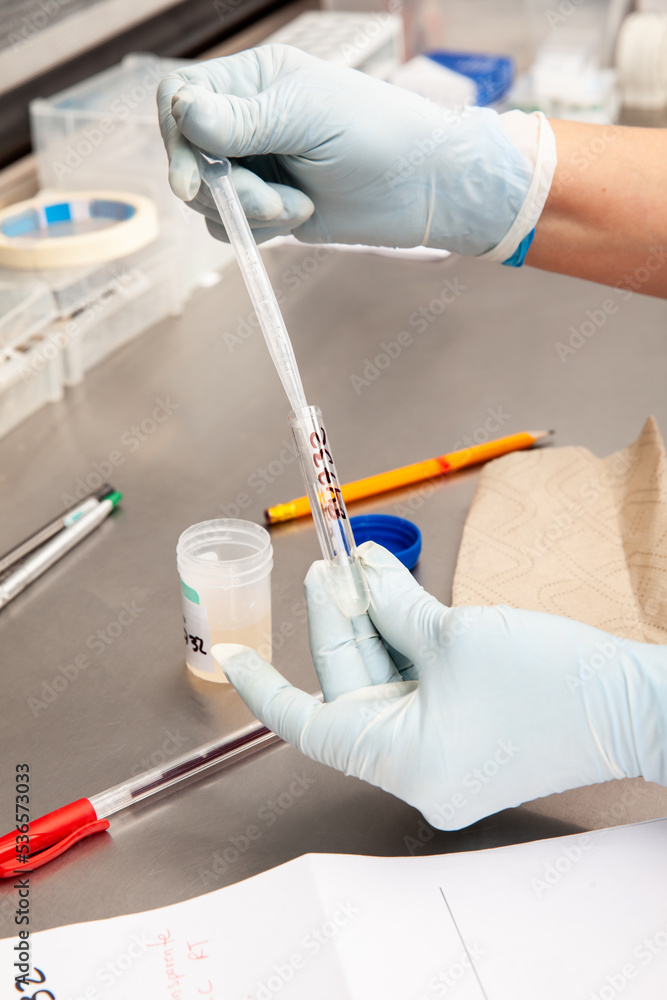 Scientist preparing a peritoneal fluid sample for cytology analysis in ...