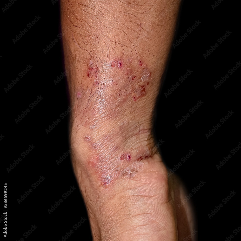 Fungal infection called tinea corporis in forearm of Asian man. Stock ...