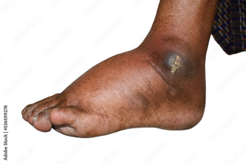 Pitting edema of lower limb. Swollen leg of Asian man. Stock Photo ...