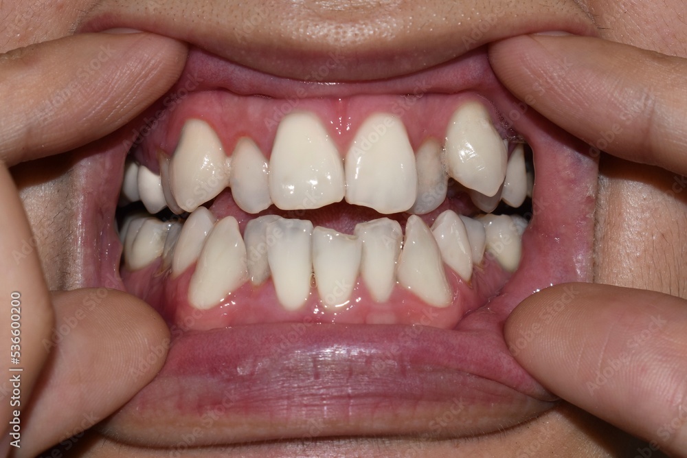 Stacked or overlapping white teeth. Also called crowded teeth. Stock ...