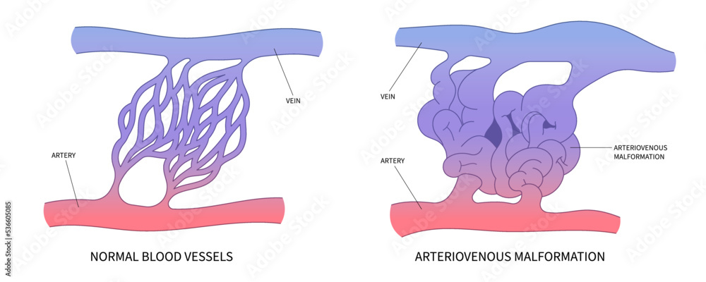 Brain stroke artery vein swelling scalp CT scan X-ray image MRI ...