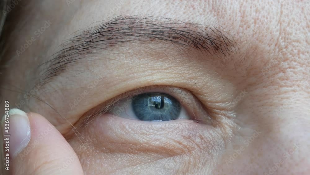 middle aged female's eye with drooping eyelid. Ptosis is a drooping of ...