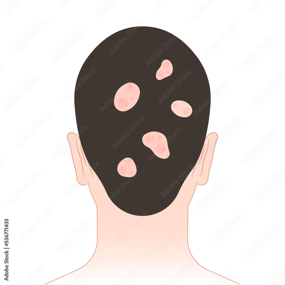 Photo & Art Print hair loss butterfly and malar rash chronic facial ...