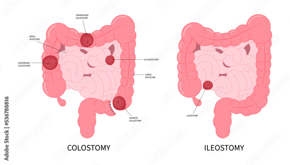 Colon Cancer Surgery for abdomen Pouch Small and Large ileum of Crohn ...