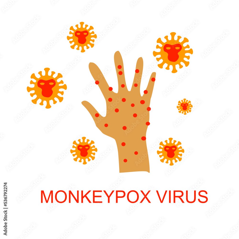Monkeypox is an infectious viral disease that can occur in humans and ...