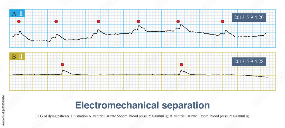 Electromechanical separation is an ECG of cardiac arrest. The heart has ...