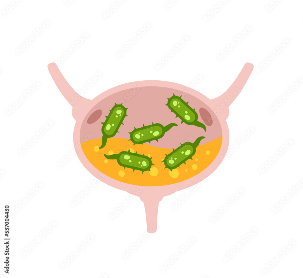 Virus in the bladder. Infection and inflammation of urine and internal ...
