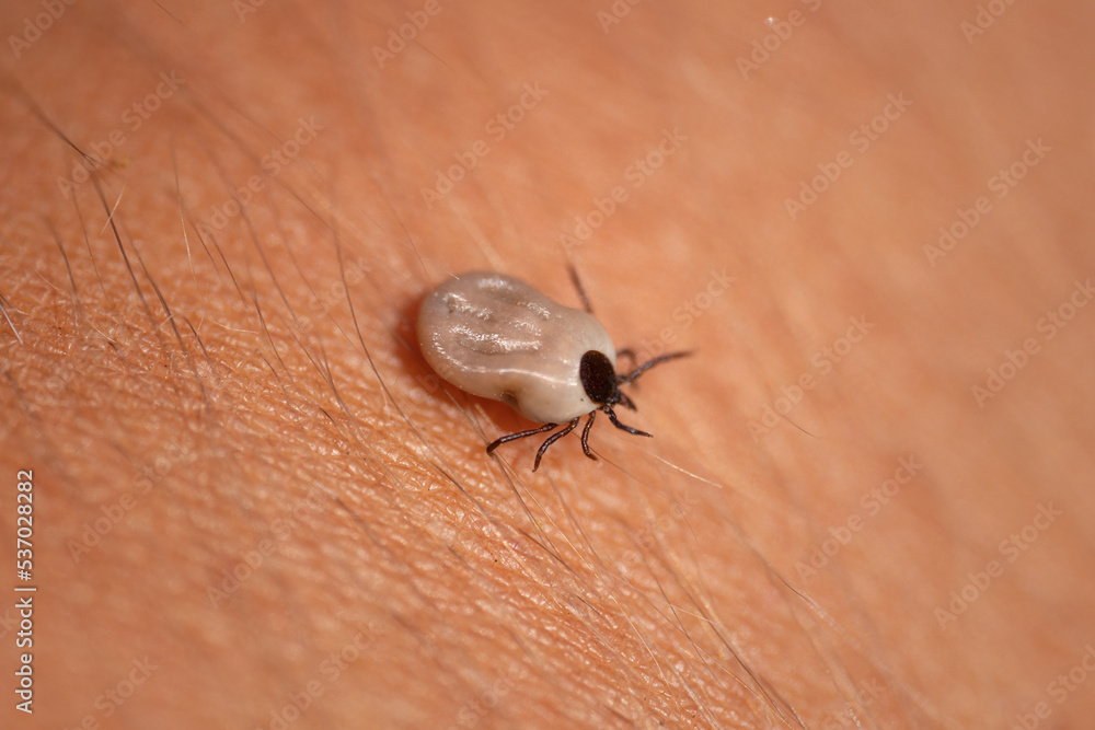 Tick filled with blood sitting on human hand skin. Ixodes ricinus or ...