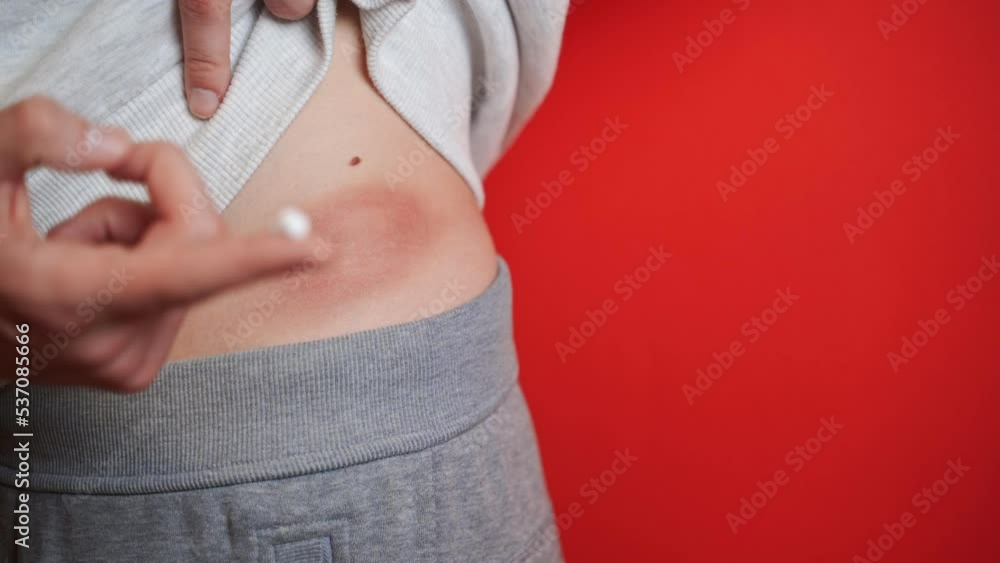 Bloody circular wound from an abdominal injury. Wound healing and ...